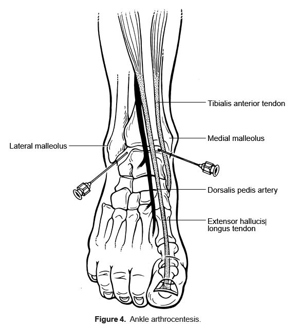 RheumaKnowledgy Arthrocentesis Injections Ankle